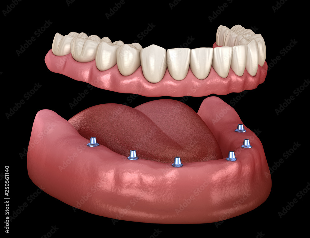 Mandibular removable prosthesis All on 6 system supported by implants ...
