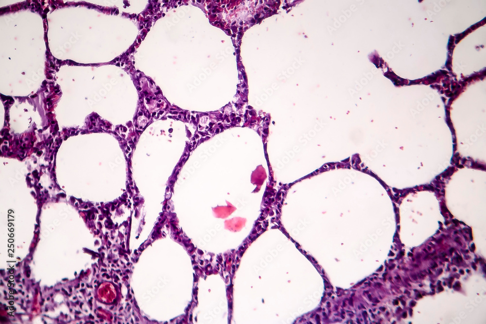 Histopathology of pneumonia, light micrograph, photo under microscope ...