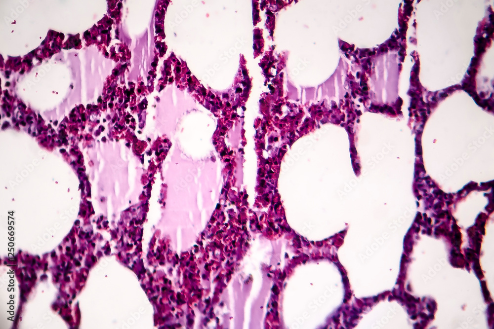 Histopathology of pneumonia, light micrograph, photo under microscope ...