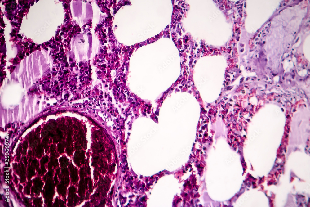 Histopathology of pneumonia, light micrograph, photo under microscope ...