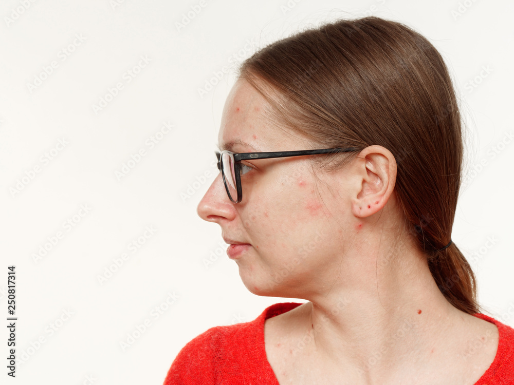 portrait of a girl without makeup. acne on the face. on a white ...