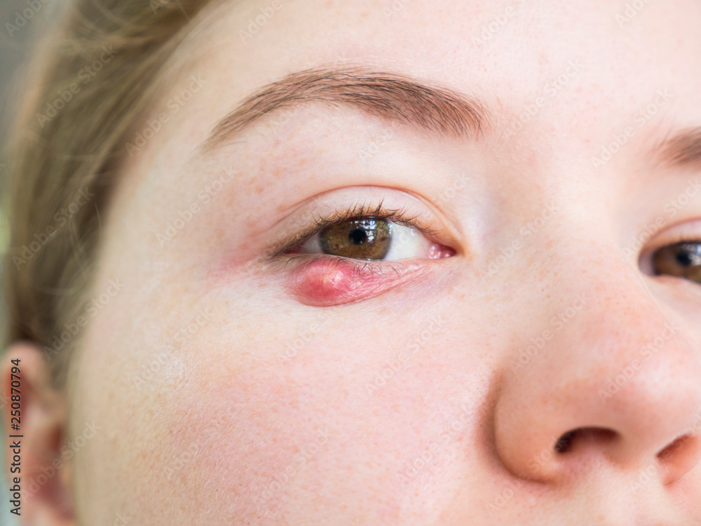 Eyelid abscess. Close up photo of young caucasian woman barley brown ...