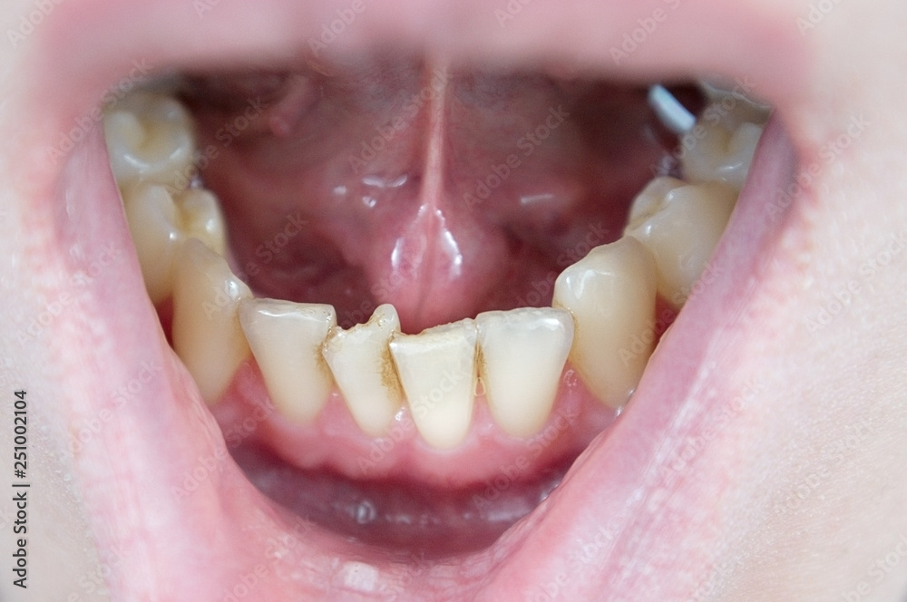 crooked teeth on the lower jaw, crowding of teeth in the anterior part ...