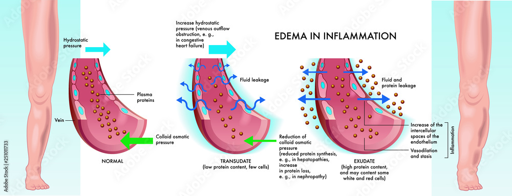 Main stages of edema inflammation illustrated in medical diagram. Stock ...
