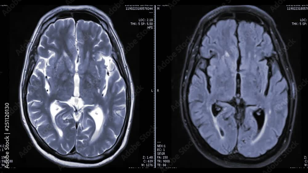 MRI brain or magnetic resonance imaging in axial view comparison T1 vs ...