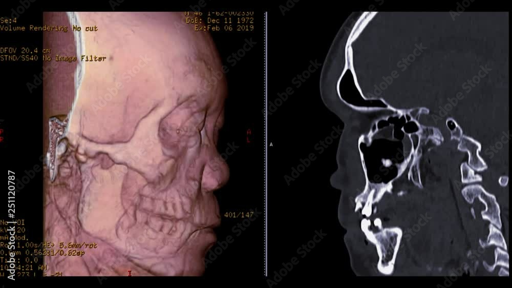 CT scan of facial bone 3D rendering image from case head injury ...