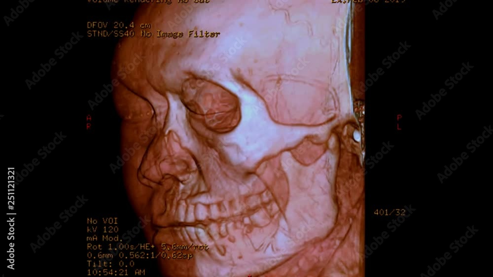 CT scan of facial bone 3D rendering image from case head injury ...