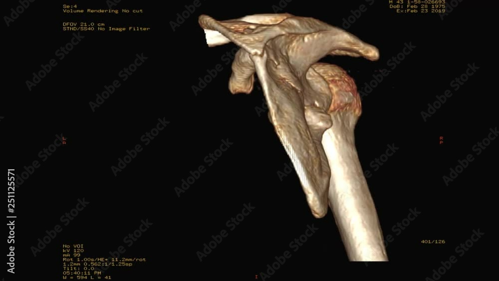 Stockvideo CT of Rt shoulder showing Fracture scapula bone 3d rendering ...
