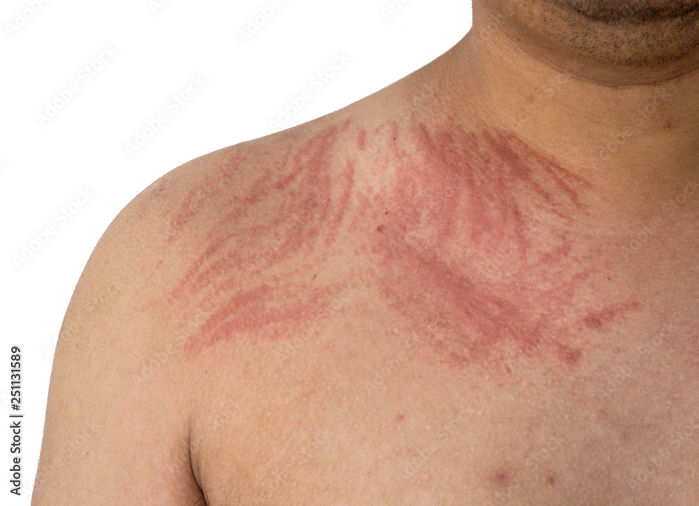 Allergy dermatographia on skin Stock Photo | Adobe Stock