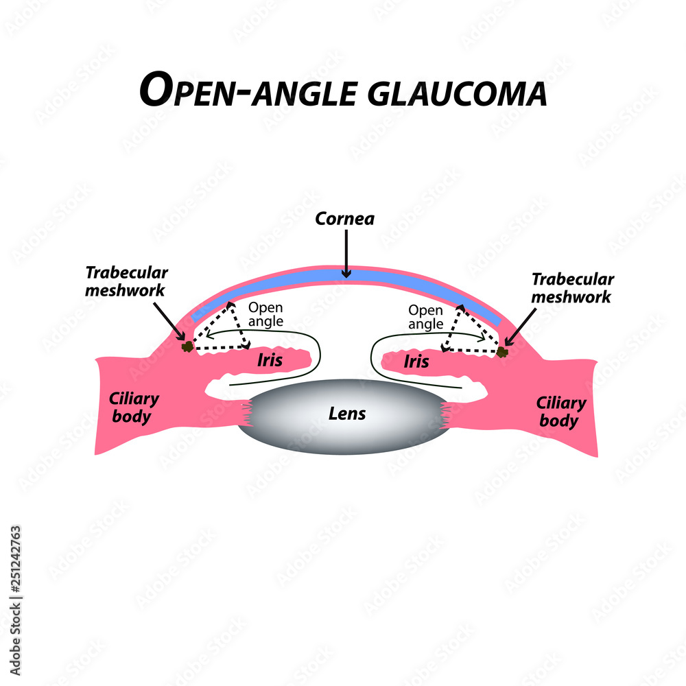 Open-angle glaucoma. A common type of glaucoma. The anatomical ...