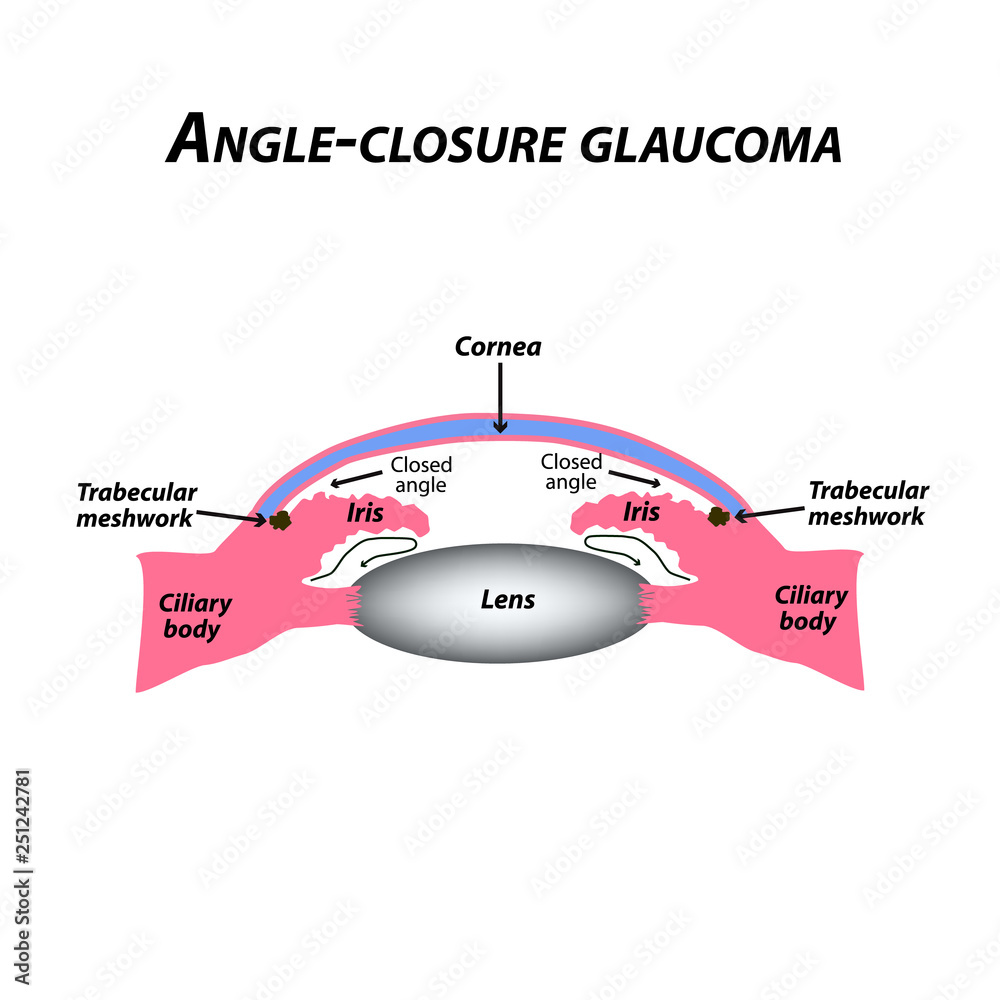 Closed angle glaucoma. A common type of glaucoma. The anatomical ...