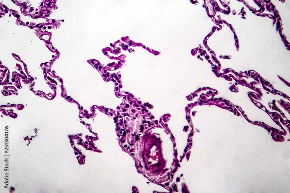 Foto Stock Histopathology of lung emphysema, light micrograph, photo ...