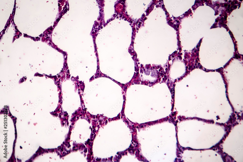 Histopathology of pneumonia, light micrograph, photo under microscope ...
