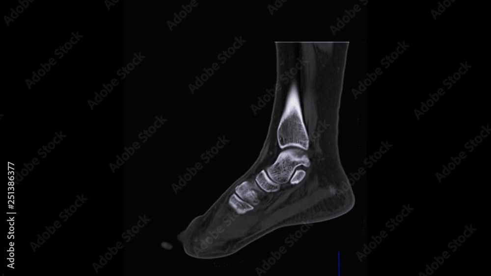 CT Scan imaging of right foot sagittal plane .medical technology ...