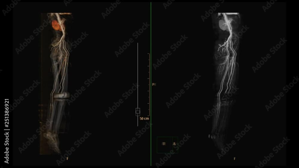 Vidéo Stock CTA femoral artery run off 3D rendering image vs MIP ...