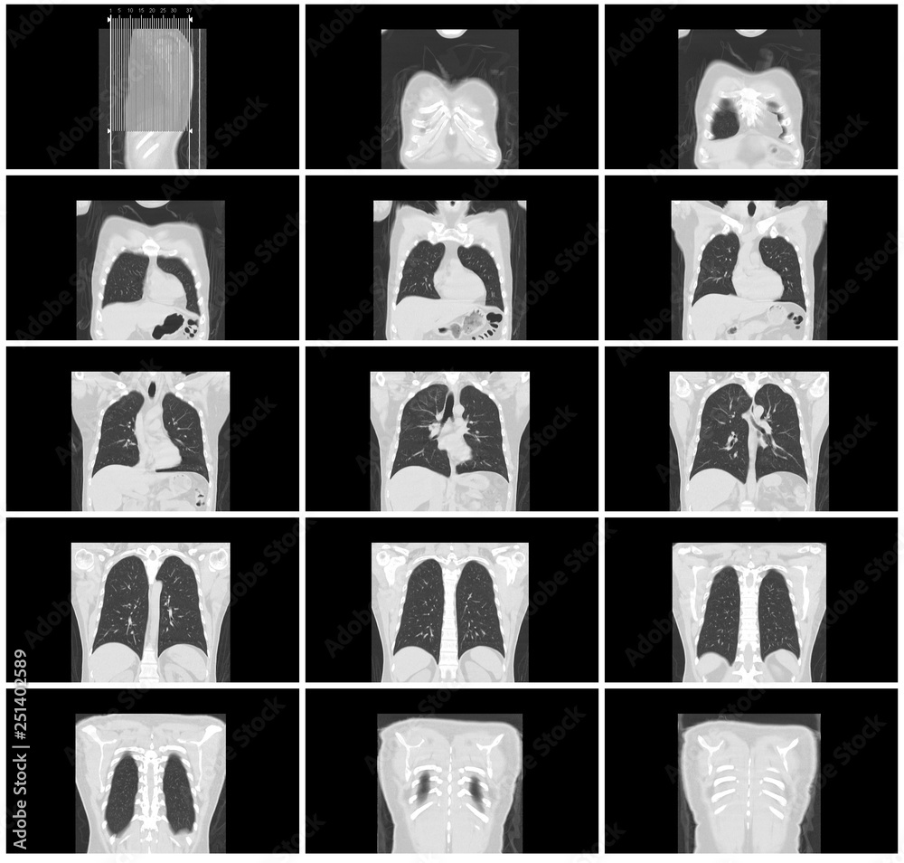 ct scan step set of body lung coronal view Stock Photo | Adobe Stock