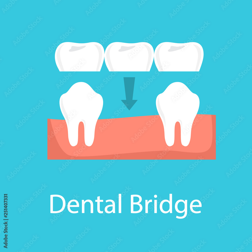 Dental bridge concept. Idea of tooth prosthesis Stock Vector | Adobe Stock
