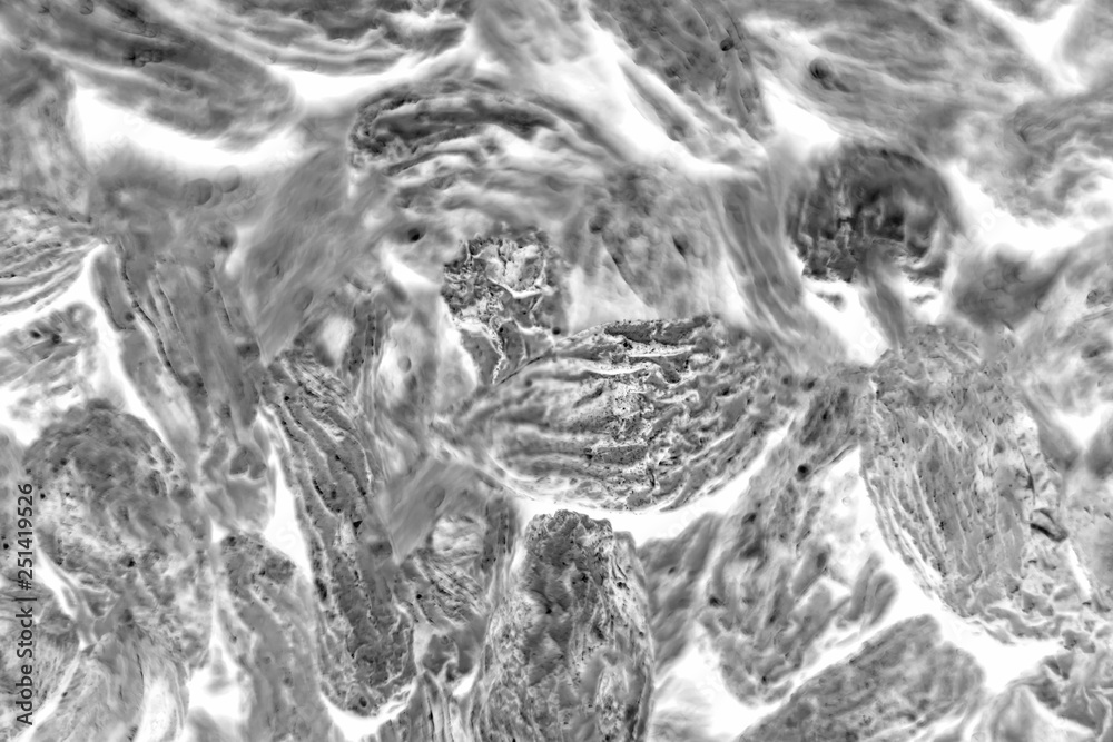 Human squamous cell carcinoma. Tissues affected by cancer cells under a ...