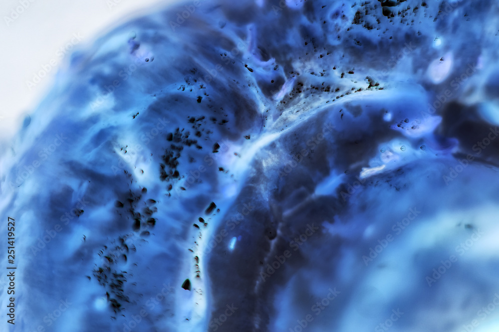 cancer cells under a microscope. Tissues affected by cancer cells under ...