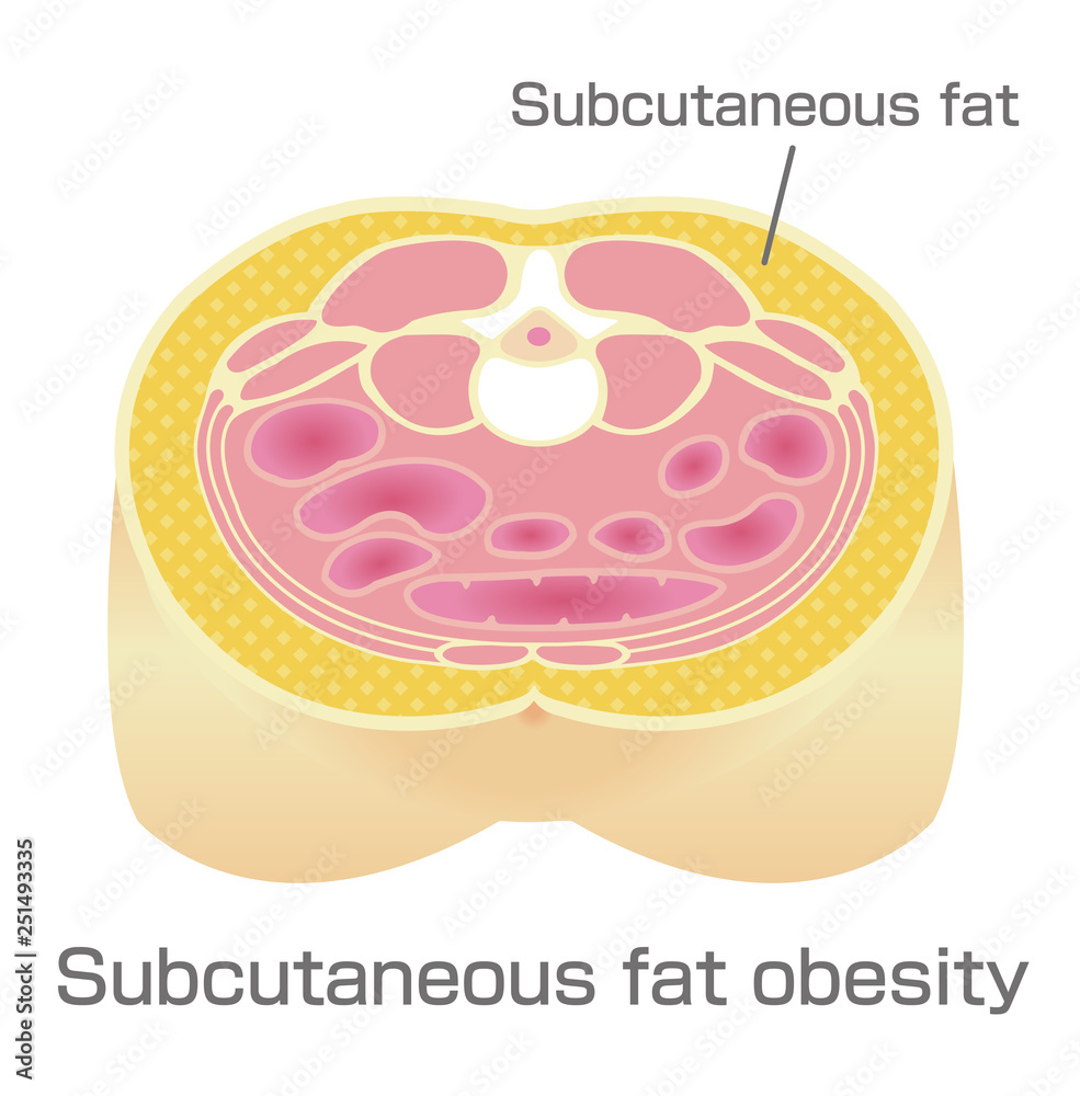 Type of obesity illustration . Abdominal sectional View (subcutaneous ...