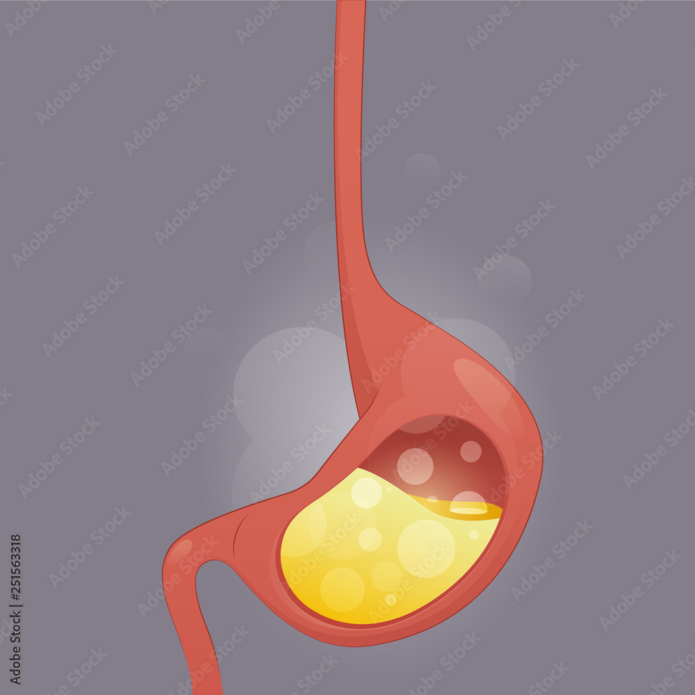 Gastroesophageal reflux disease, Acid reflux, Heartburn and GERD ...