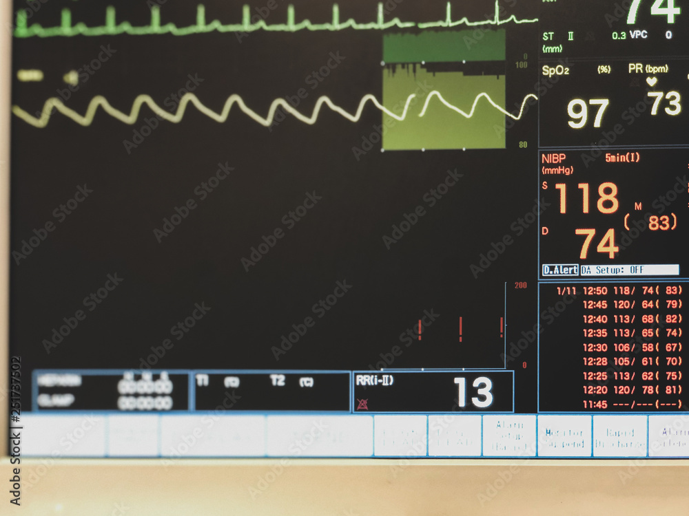 A vital signs monitor displaying a patient's ECG, pulse oximetry ...
