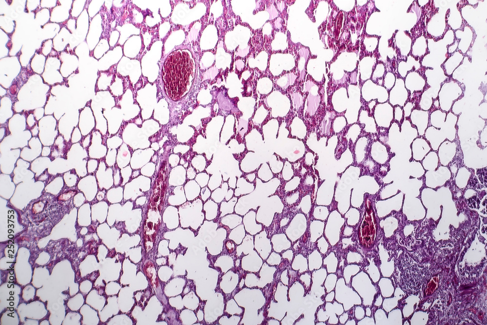 Histopathology of pneumonia, light micrograph, photo under microscope ...