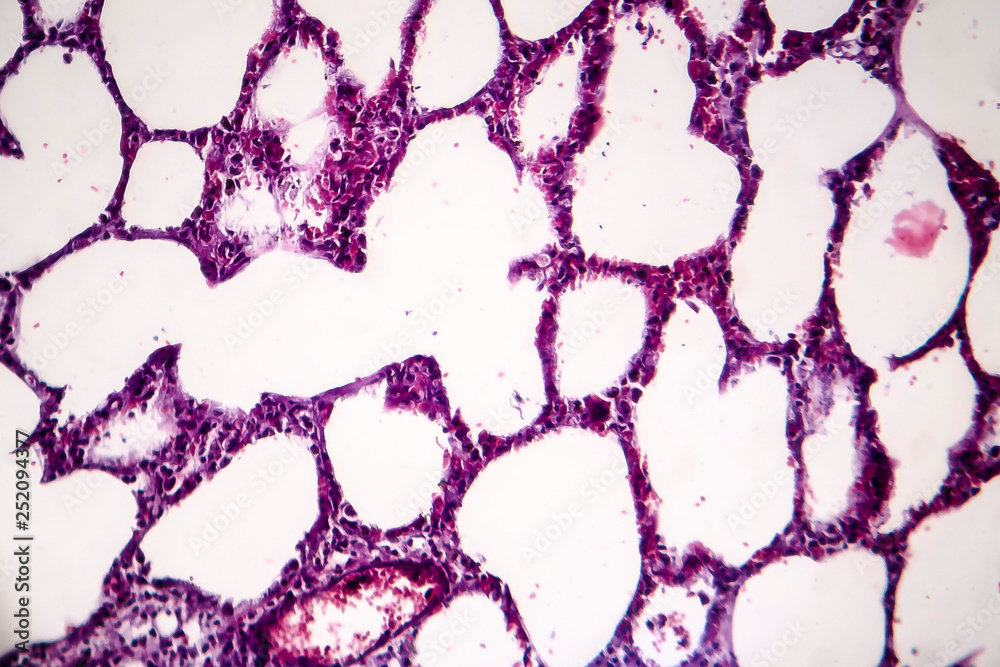 Histopathology of pneumonia, light micrograph, photo under microscope ...