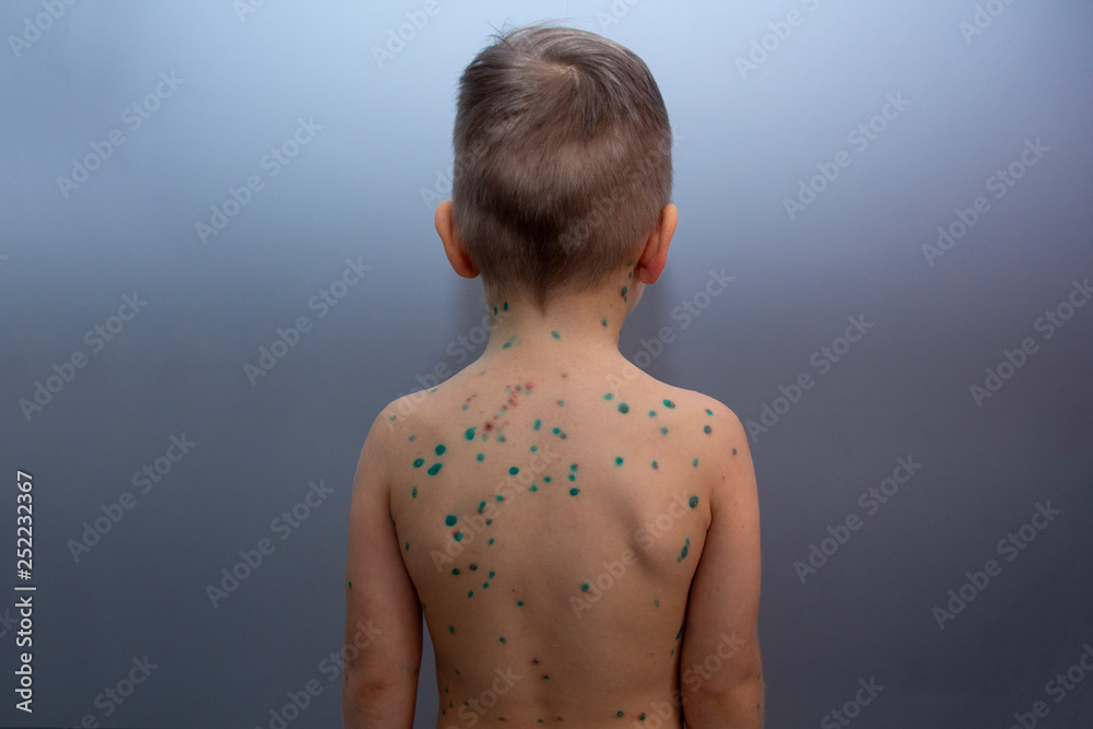 Sad Boy With Chickenpox. Sick Child Chicken Pox. Portrait of Young Boy ...