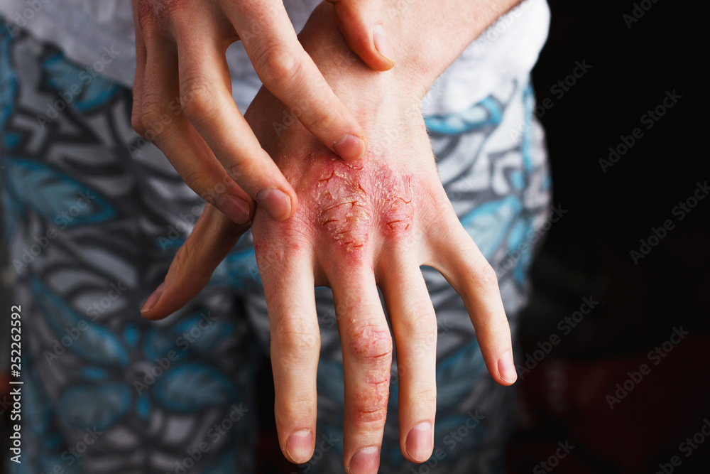 Man scratch oneself, dry flaky skin on hand with psoriasis vulgaris ...