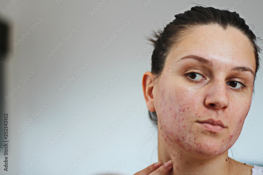 Acne on the face of young women. Improper therapy has led to a severe ...