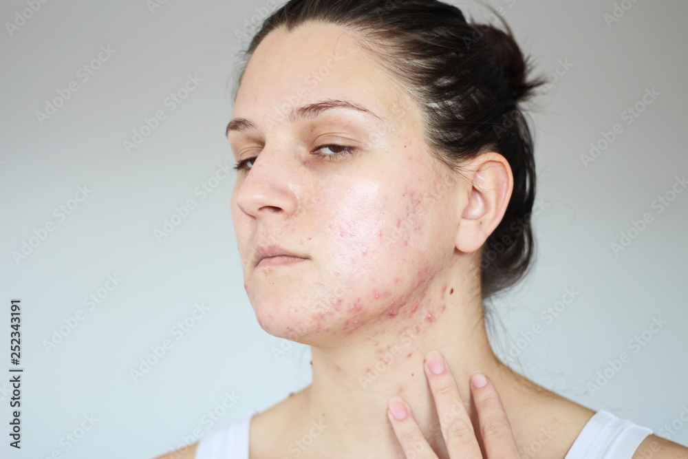 Acne on the face of young women. Improper therapy has led to a severe ...