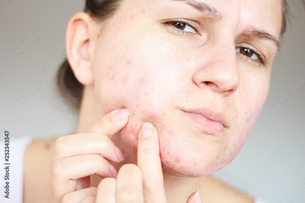 Acne on the face of young women. Improper therapy has led to a severe ...