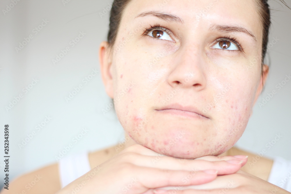 Acne on the face of young women. Improper therapy has led to a severe form of chronic ...