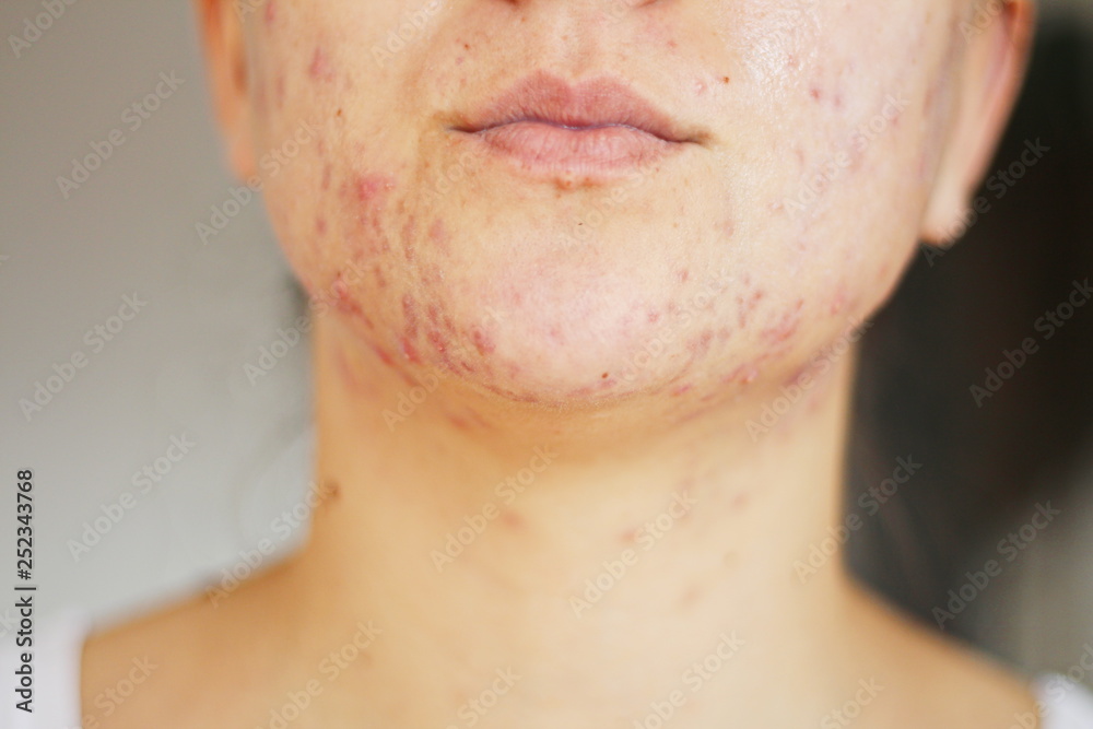 Acne on the face of young women. Improper therapy has led to a severe ...