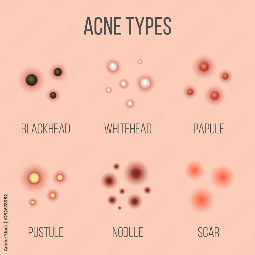 Creative vector illustration types of acne, pimples, skin pores ...