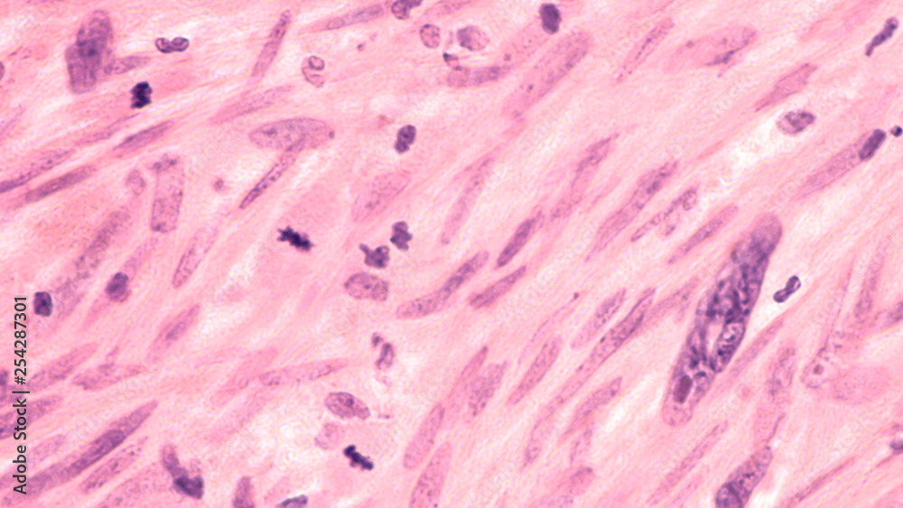 Microscopic image of a leiomyosarcoma, a type of soft tissue sarcoma of ...