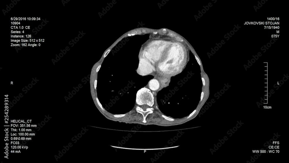 Ct Scan Computed Tomography Of Whole Abdomen With Contrast Computed