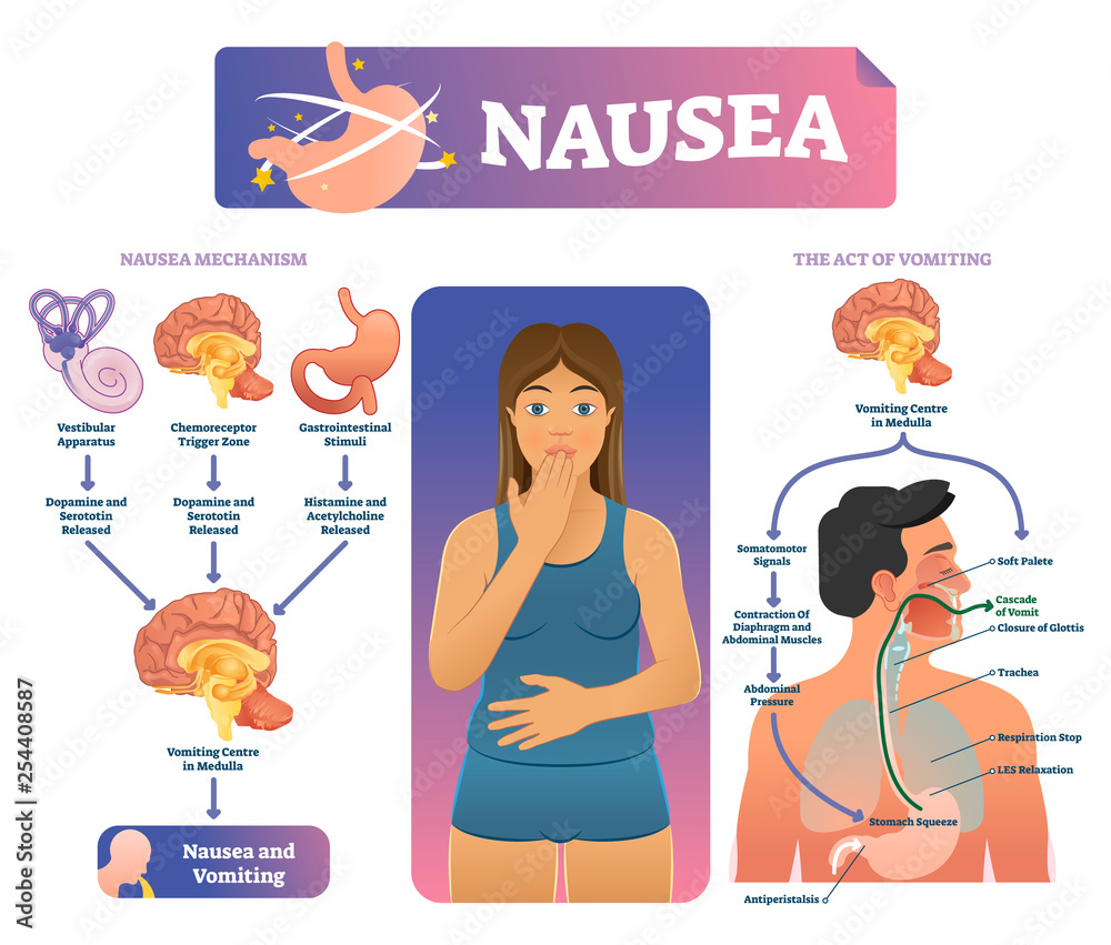 Nausea vector illustration. Labeled medical vomiting explanation scheme ...