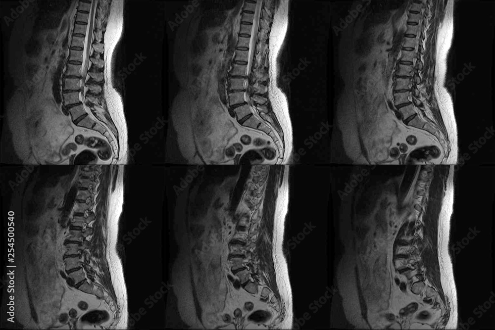 CT Computed tomography scans of human spine on a ultrasound computer ...