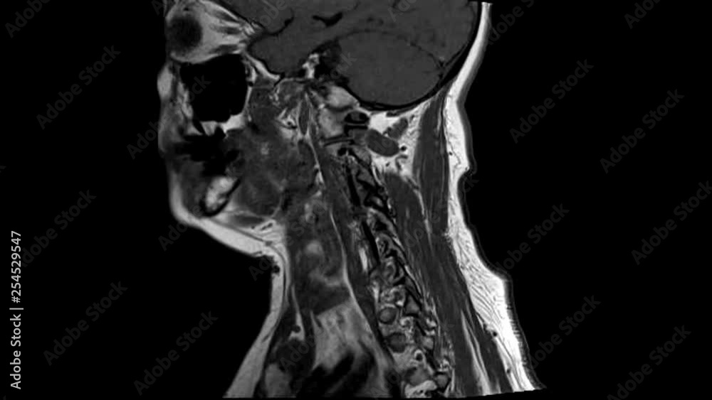 Magnetic resonance imaging of human spine. MRI of Lumbar & Thoracic ...