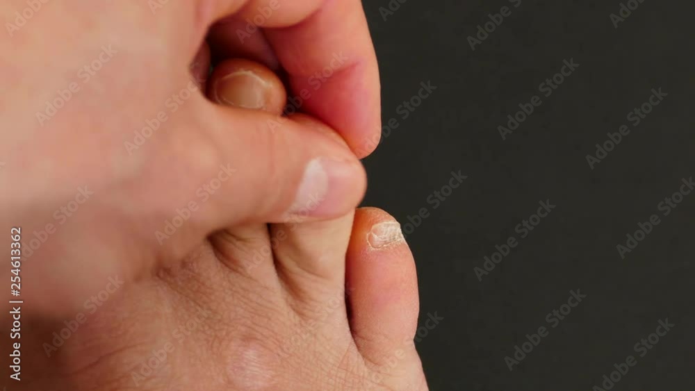 athlete's foot, ringworm between the toes, Fungal disease between toes ...