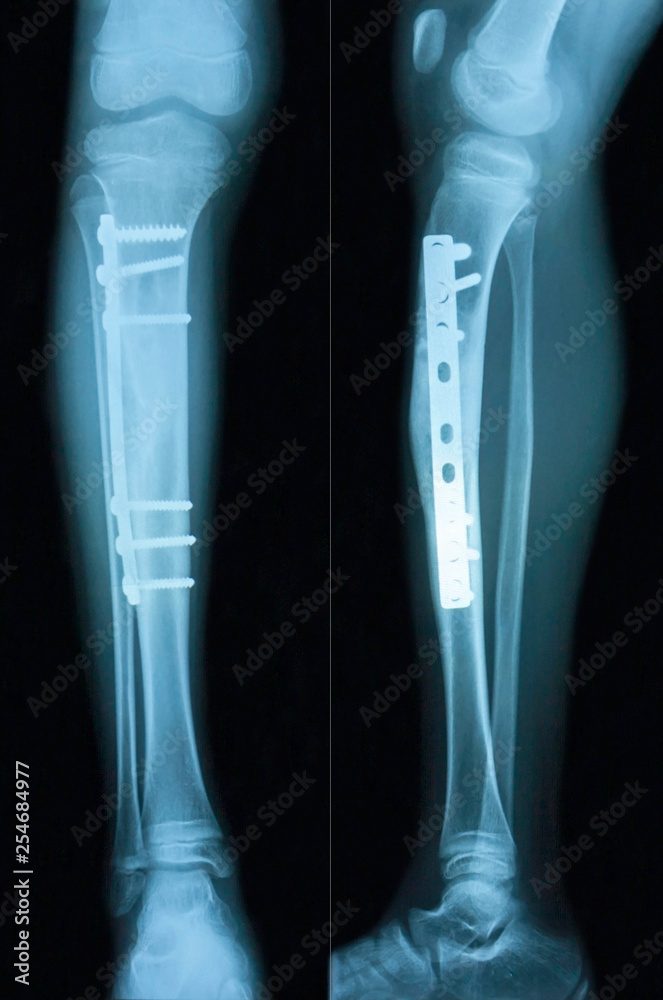 Film x-ray show fracture shaft of tibia and fibular insert plate and ...