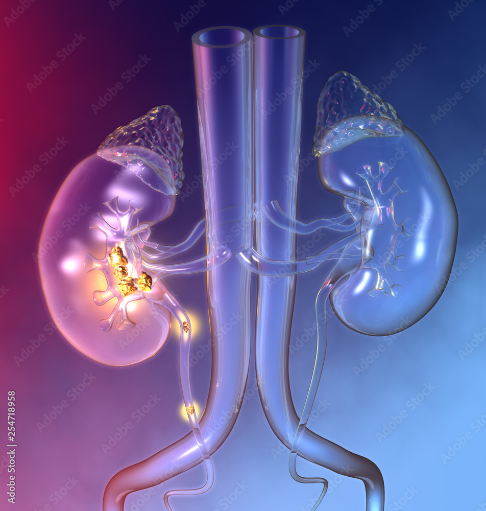 Kidney stones in minor and major calyces and ureter, colorful medically ...