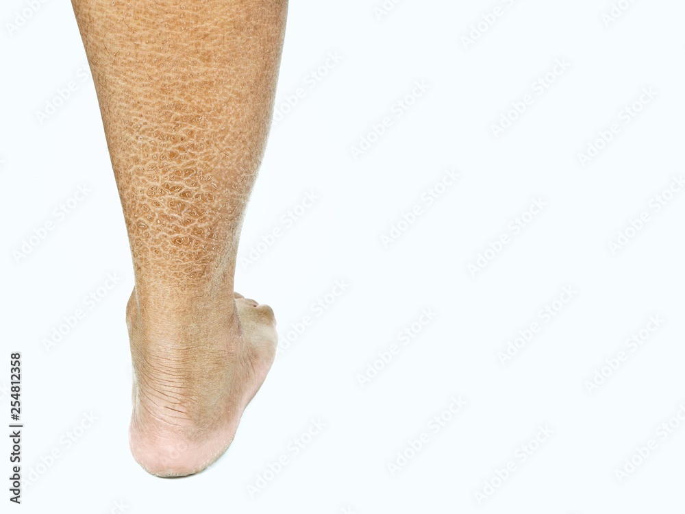 Dry and cracked skin , Ichthyosis vulgaris. Stock Photo | Adobe Stock