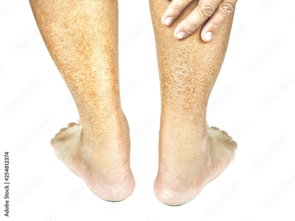 Dry and cracked skin , Ichthyosis vulgaris. Stock Photo | Adobe Stock