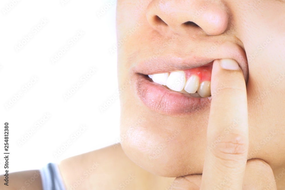 Inflammation of the gums and teeth. Stock Photo | Adobe Stock