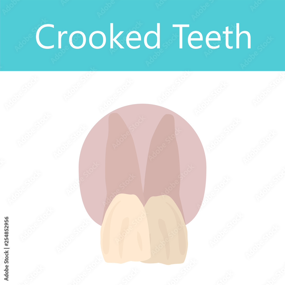 Croocked Teeth. Vector dental anatomy illustration. White background ...