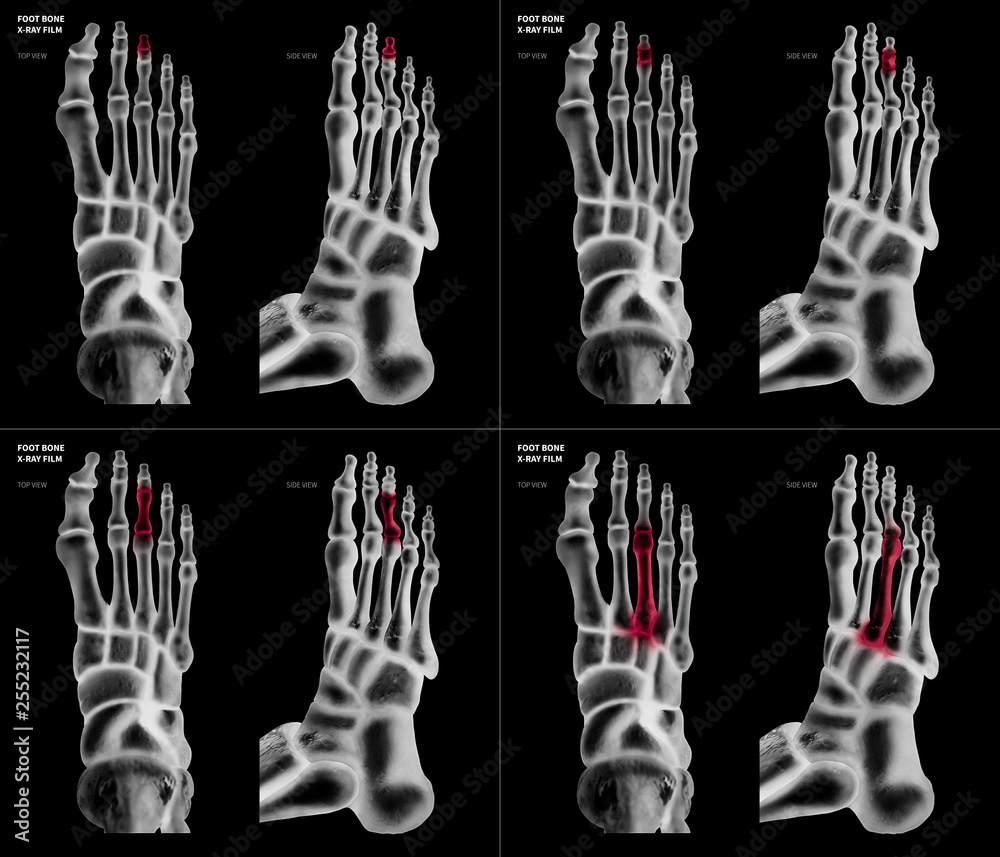 X-ray film collection of Middle toe foot bone with red highlights on ...