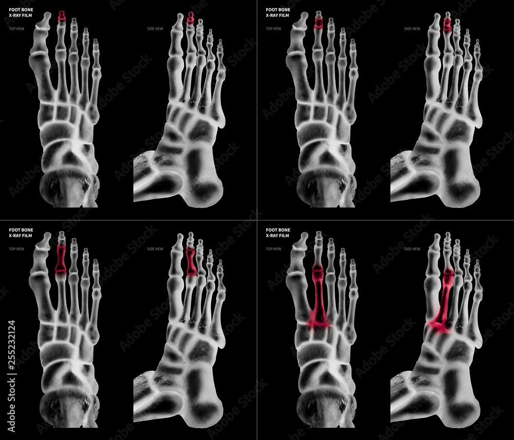 X-ray film collection of Long toe foot bone with red highlights on ...